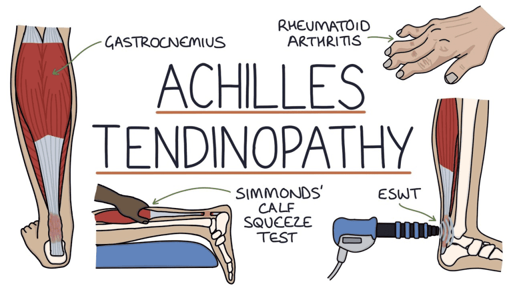 Assessing And Treating Achilles Tendinopathy: A Guide For Evidence-Based Chiropractors - Gard ...
